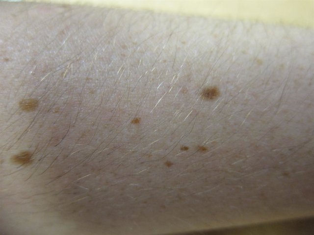 Identifican un gen asociado a los ojos azules o las pecas