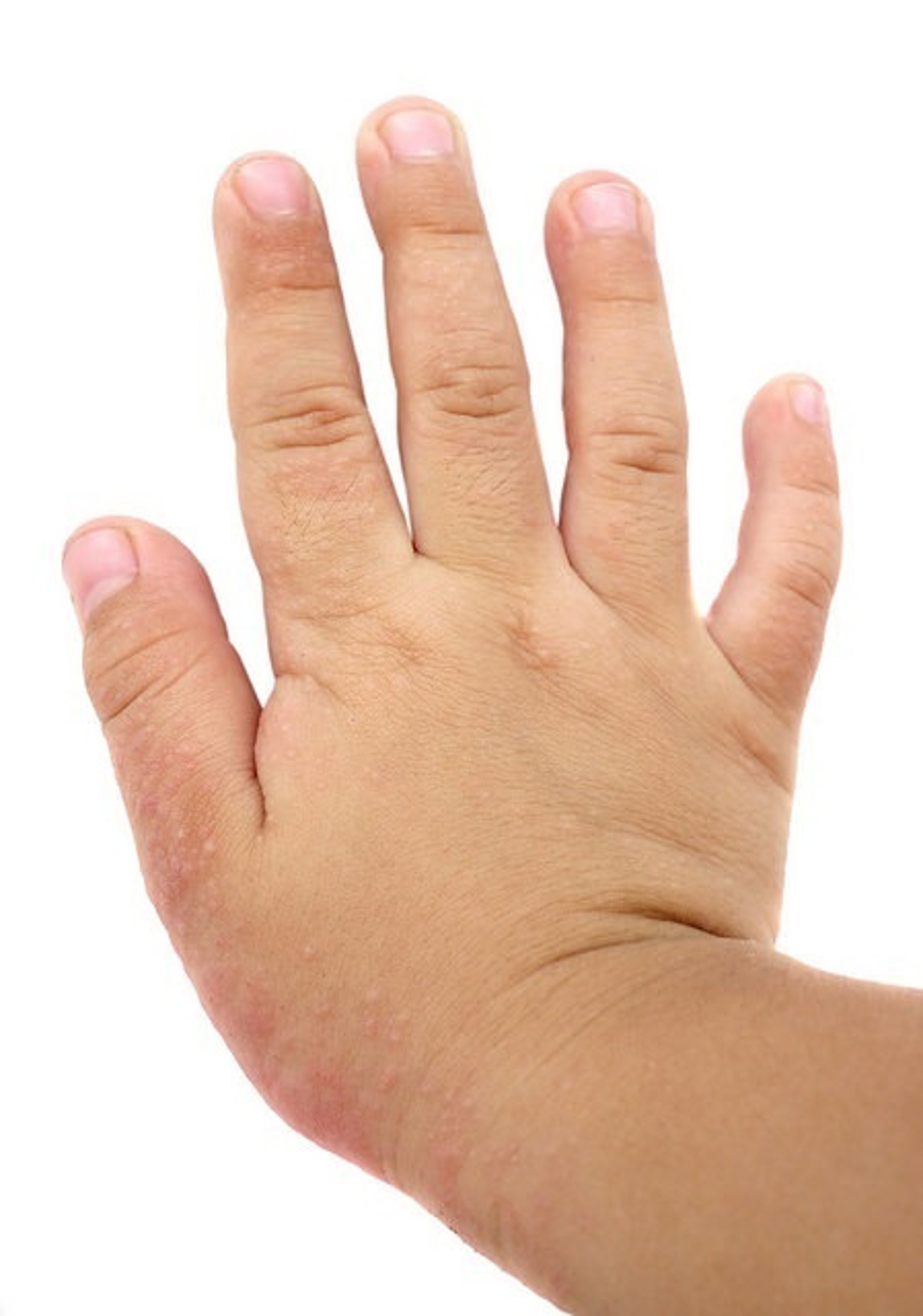 El frío seco agrava los síntomas de la dermatitis atópica infantil