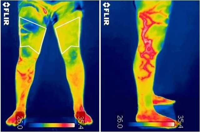 La termografía infrarroja, útil en el diagnóstico en traumatología