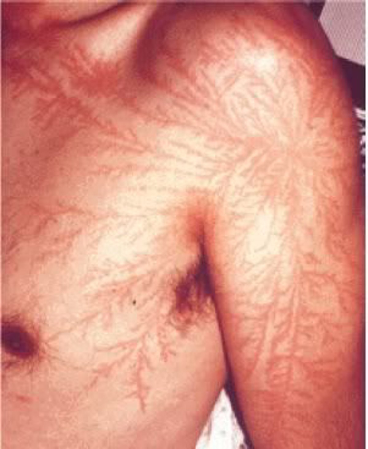 Figuras de Lichtenberg: Esto es lo que le pasa a tu piel si te alcanza ...