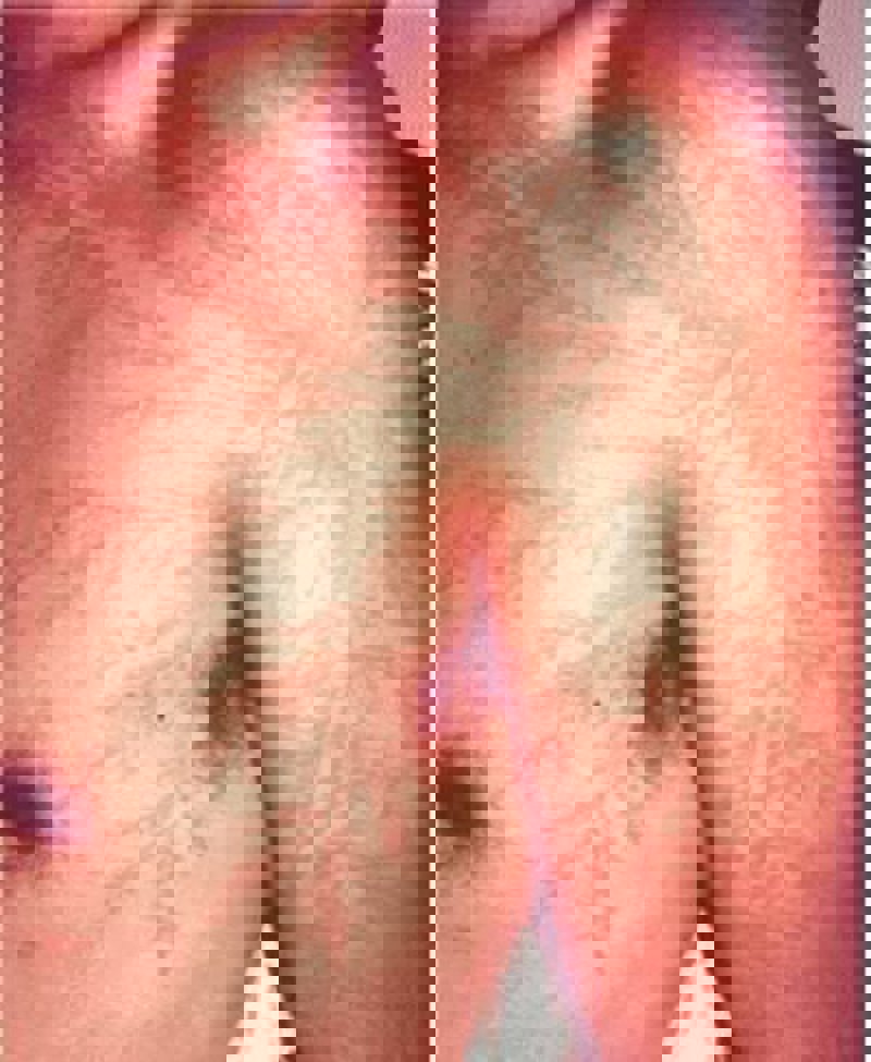 Figura De Lichtenberg Na Pele - BRAINCP