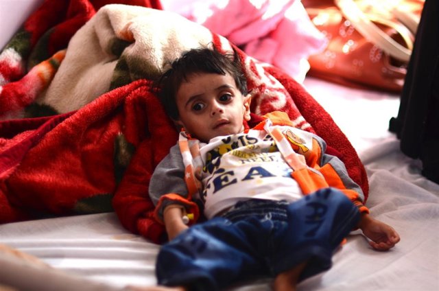 Los hospitales de Yemen, sin medicamentos para los niños desnutridos