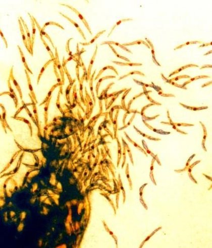 Parasitología : Mecanismos de acción patógena del Paragonimus y cuadro ...