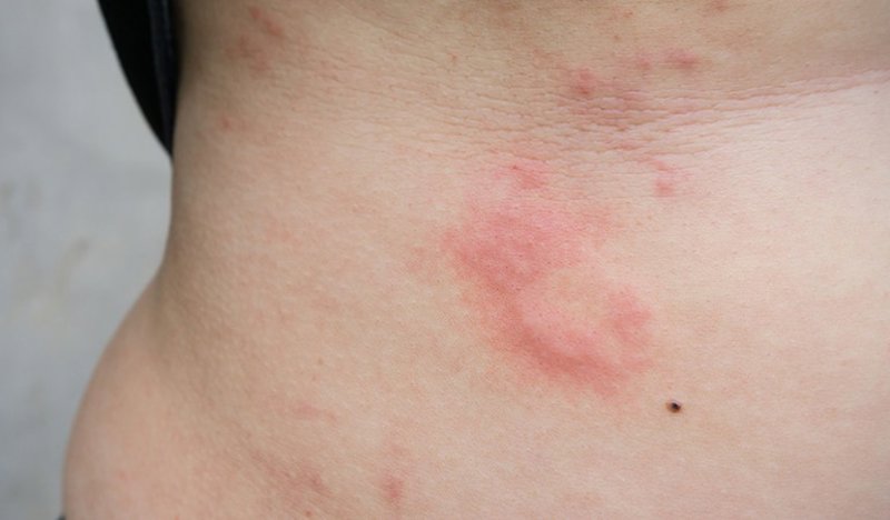La Urticaria Crónica No Es Banal Qué Es Y Cómo Incapacita La