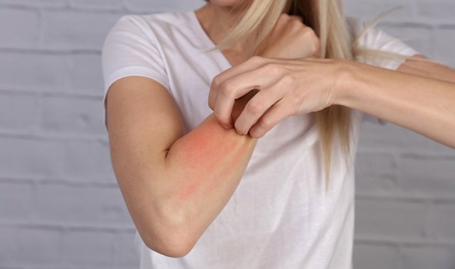 ¿por Qué Se Produce La Urticaria Crónica ¿cuáles Son Sus Síntomas