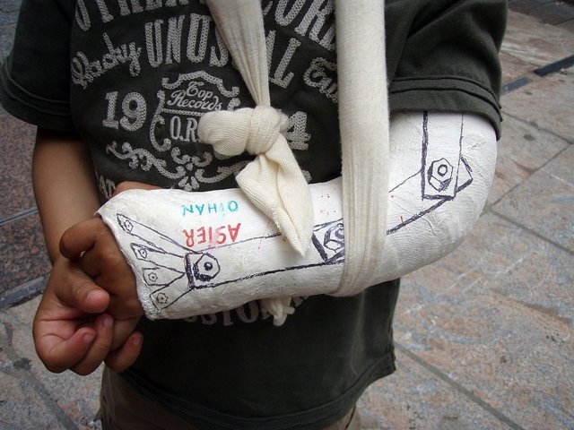 ¿Tienes un brazo escayolado? Fortalecer el otro brazo puede evitar que ...